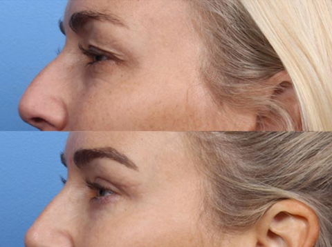 Blepharoplasty, Eyelid Tuck in Brantford, Ontario